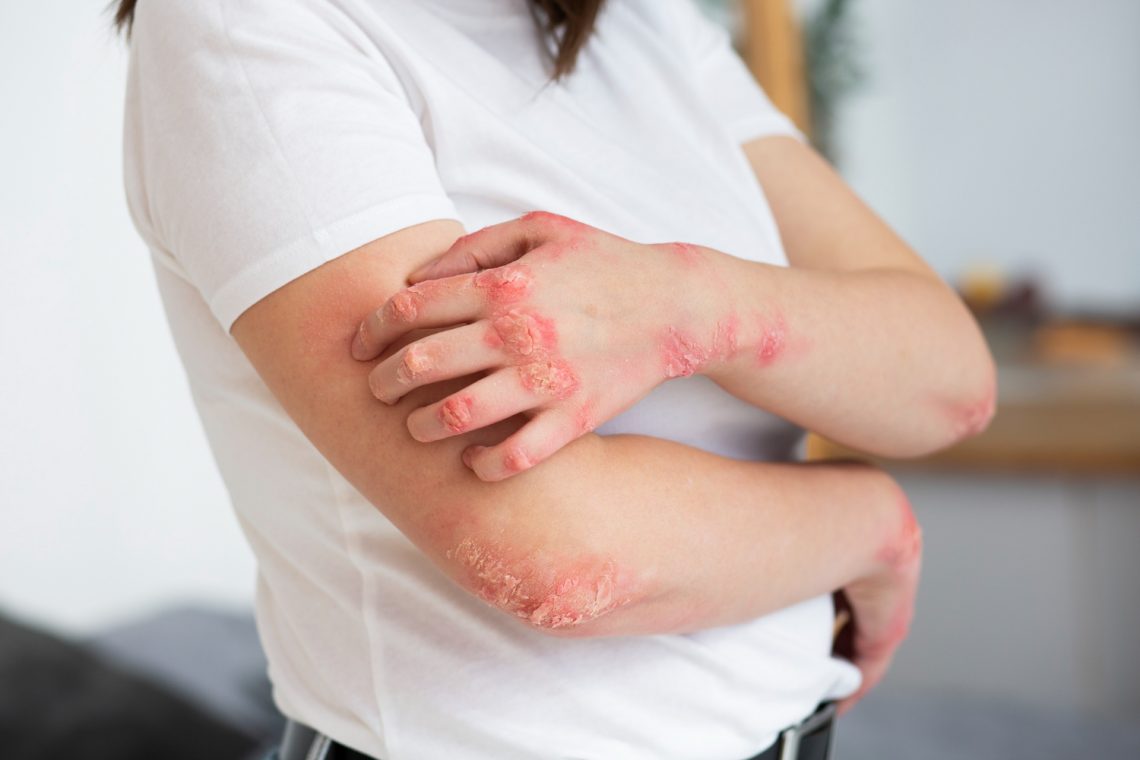Dermatitis atópica: síntomas y tratamientos más usuales